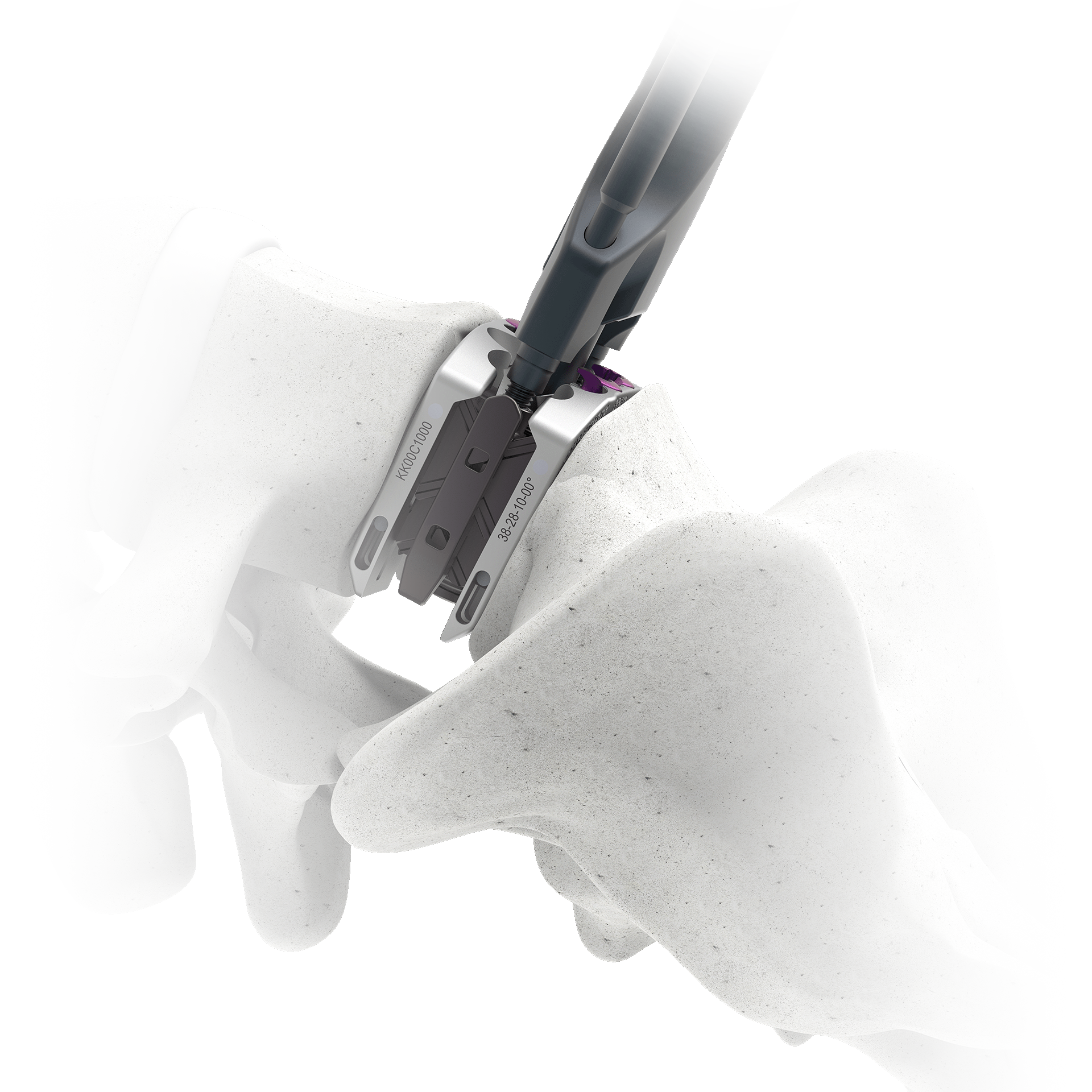 Astura Medical Announces Initial Case and Full Commercial Release For ...